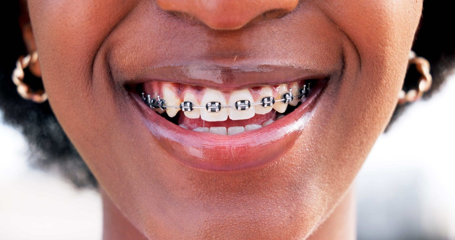 Spacers for Braces: What They Are and What to Expect